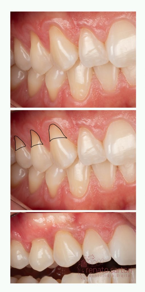Retração gengival: saiba como evita-la – Dr. Renato Sartori