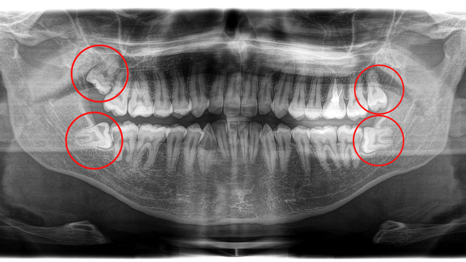 Extração de Siso – Dr. Renato Sartori - Odontologia Digital