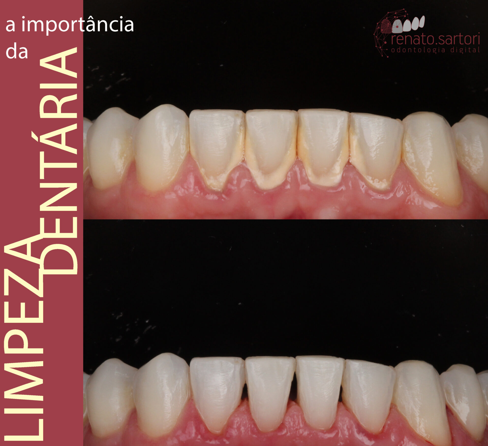 Limpeza Dentária – Dr. Renato Sartori - Odontologia Digital Limpeza Dentária – Dr. Renato Sartori - Odontologia Digital