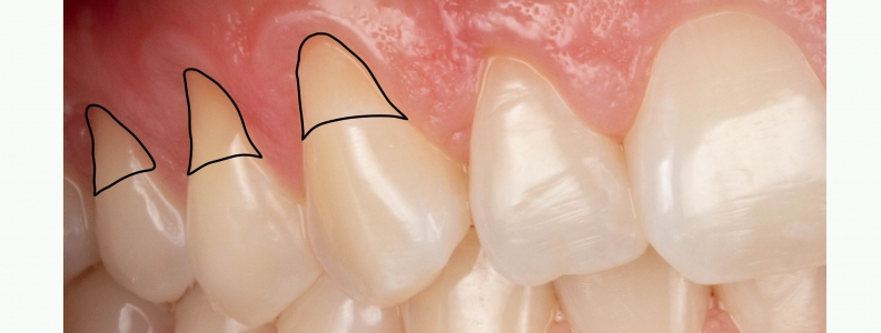 Retração gengival: saiba como evita-la – Dr. Renato Sartori