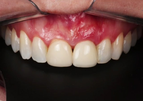 Implante Dentário – Dr. Renato Sartori - Odontologia Digital