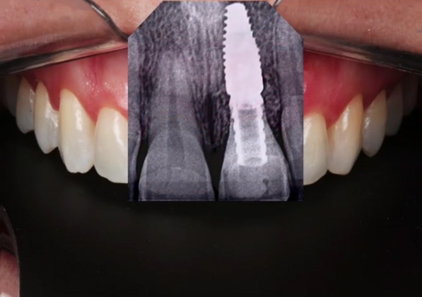 Implante Dentário – Dr. Renato Sartori - Odontologia Digital